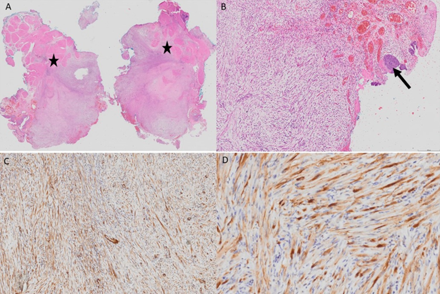 Pediatric inflammatory myofibroblastic tumor of the urinary bladder: a ...